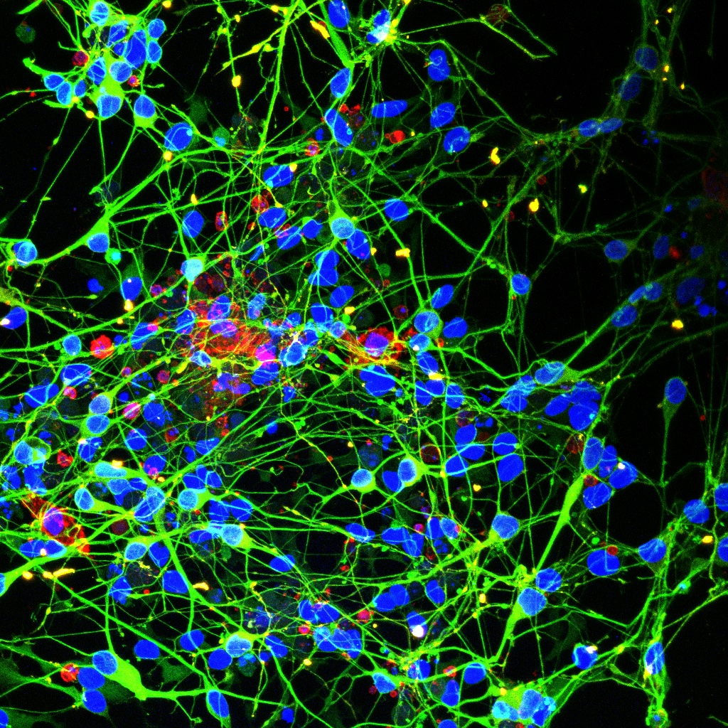 Breakthrough in Langerhans Cell Histiocytosis Research: Stem Cell Model ...